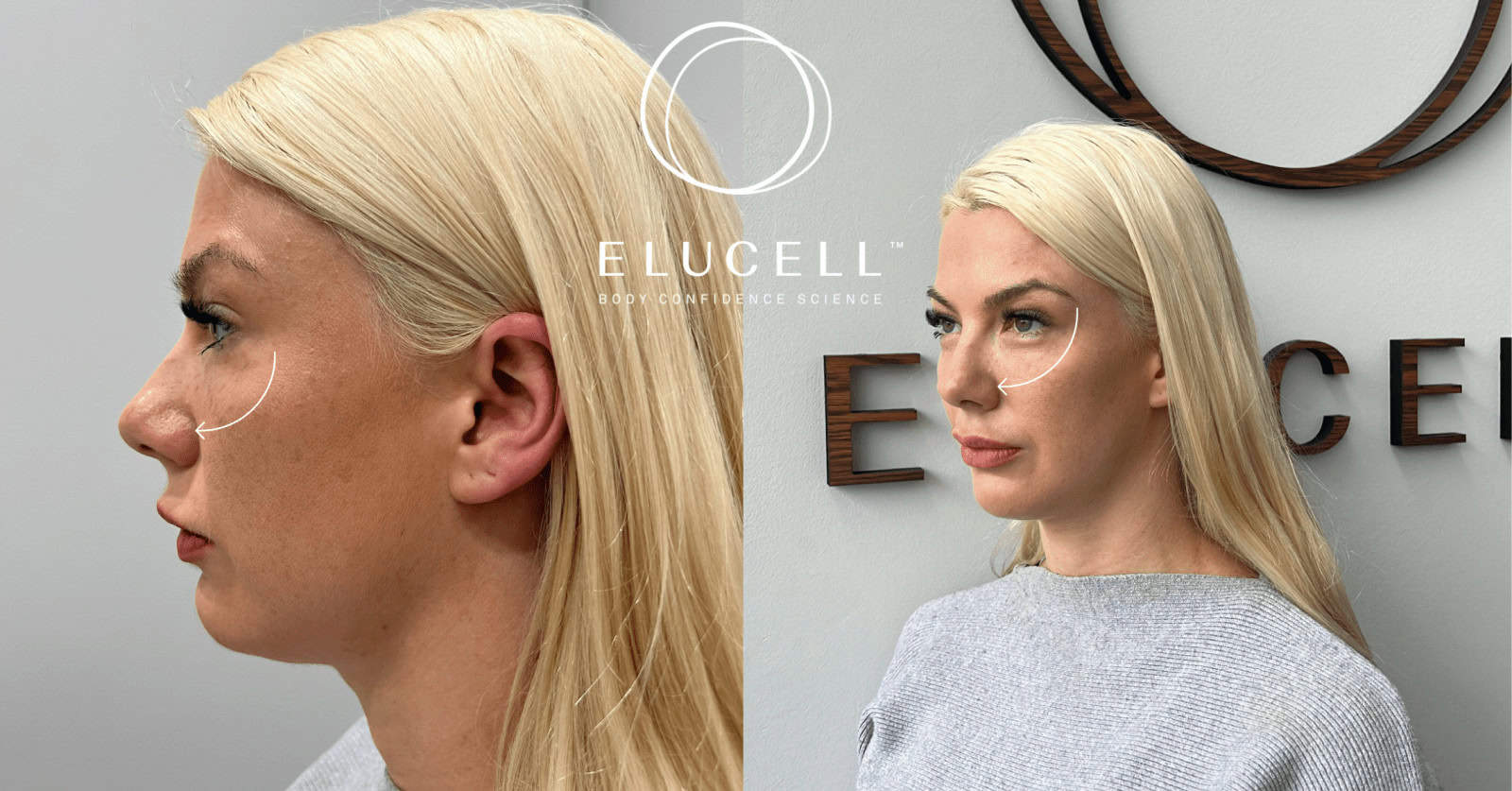 About non surgical facelift with thread lift melbourne - Elucell