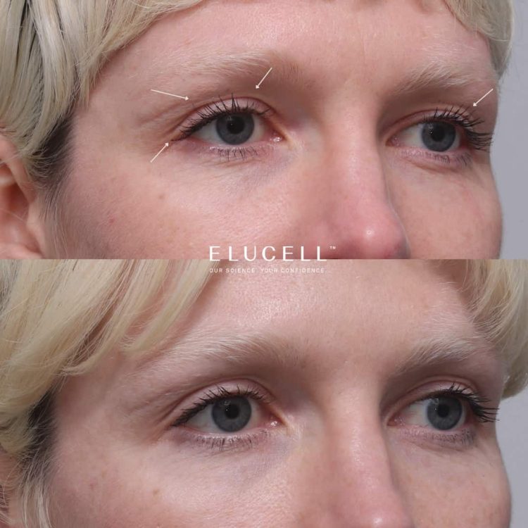 Thread lift before and after - Elucell