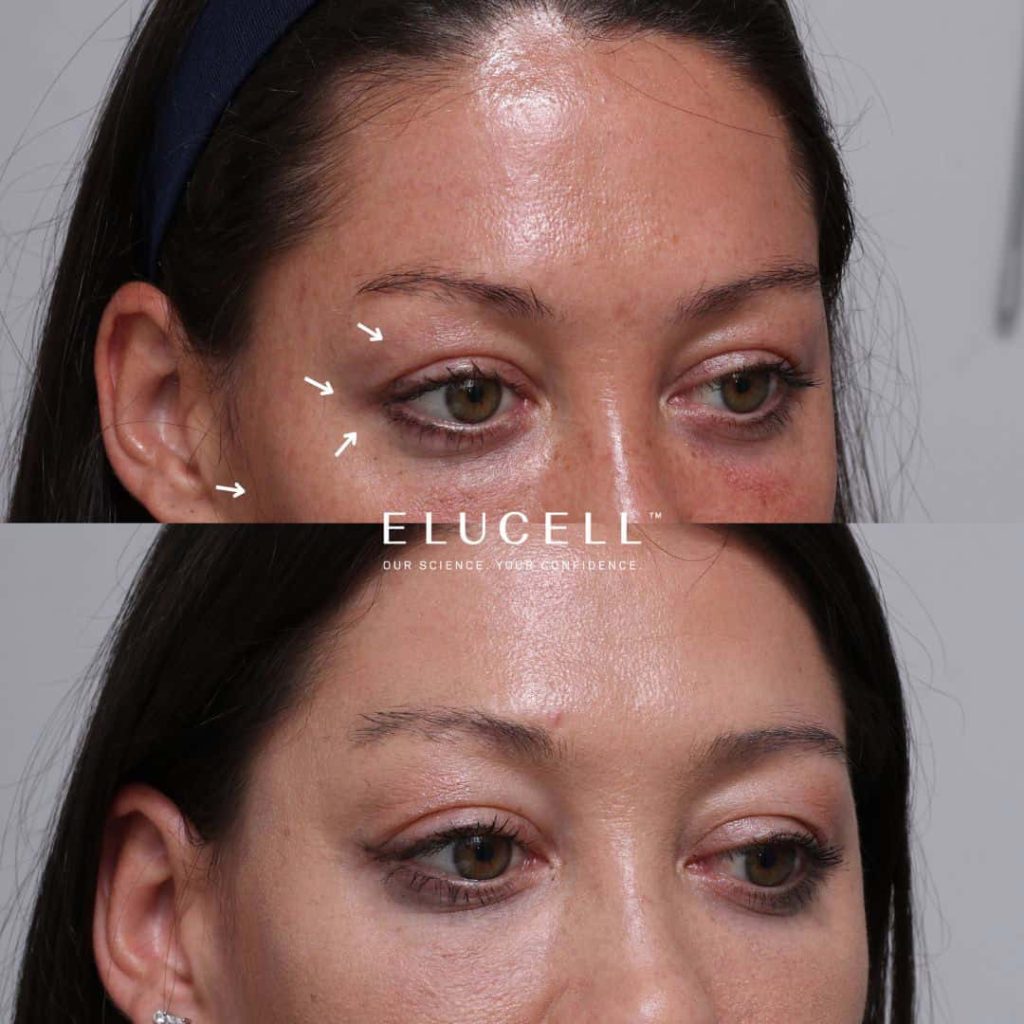 Brow Lift - Fox Eye Thread Lift Melbourne - Elucell