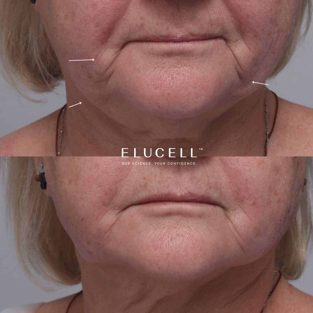 Lower Face Thread Lift Treatment Melbourne - Elucell - Elucell