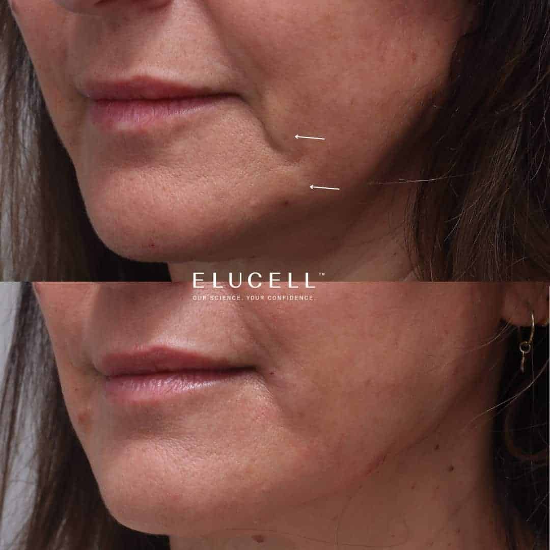 Lower Face Thread Lift Treatment Melbourne - Elucell - Elucell