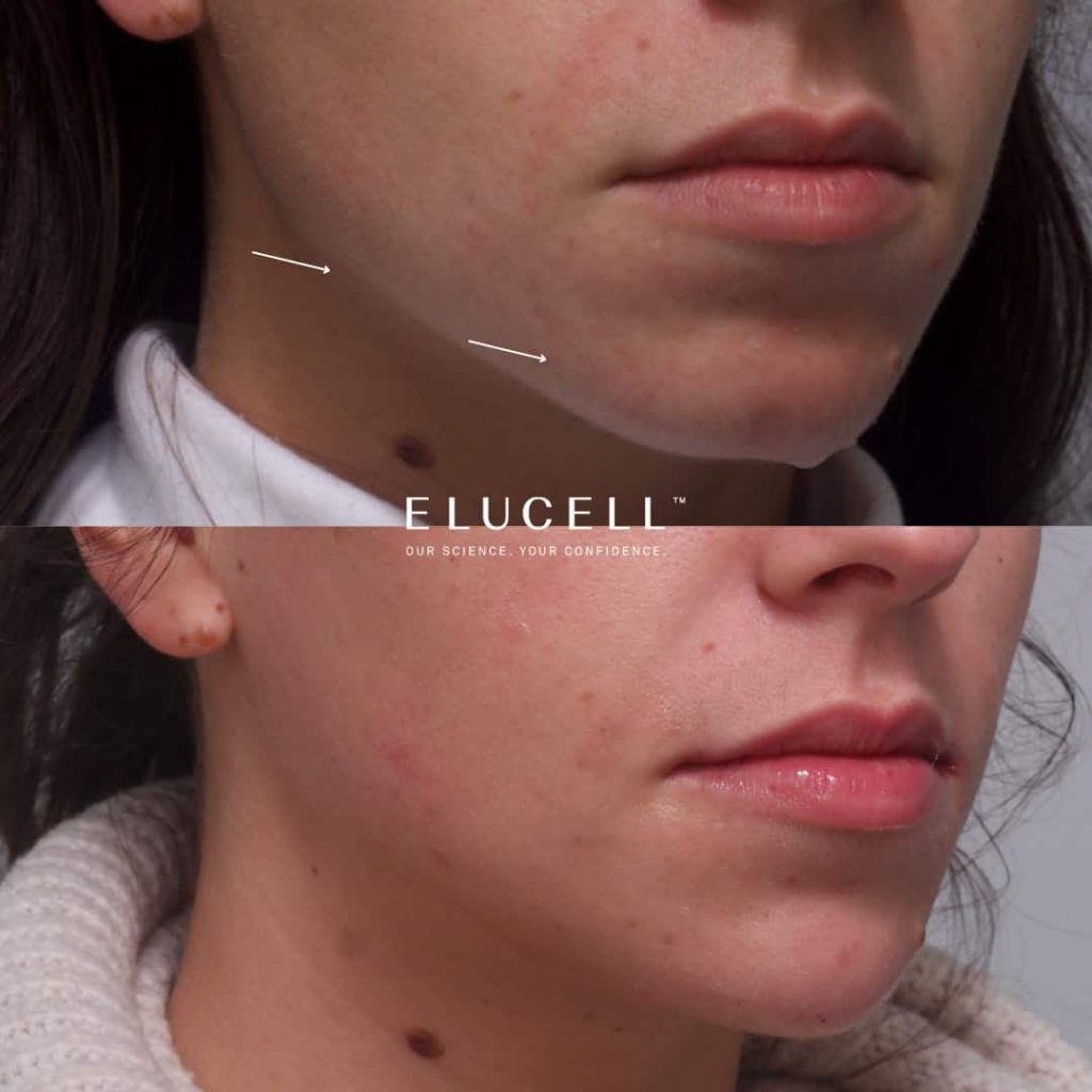Mono Rejuvenation Threads For Skin Tighening - Elucell - Elucell