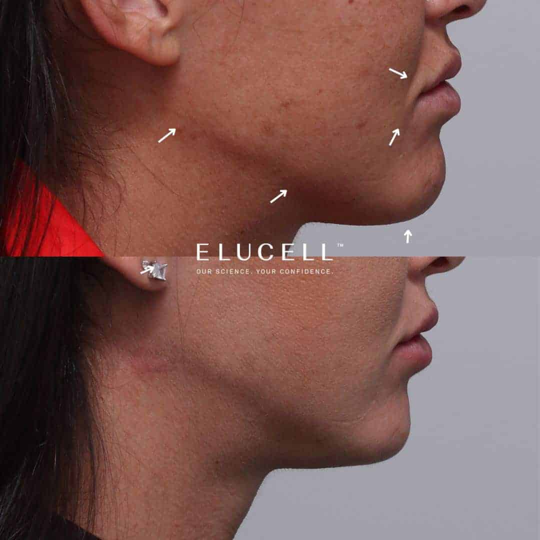 Lower Face Thread Lift Treatment Melbourne - Elucell - Elucell