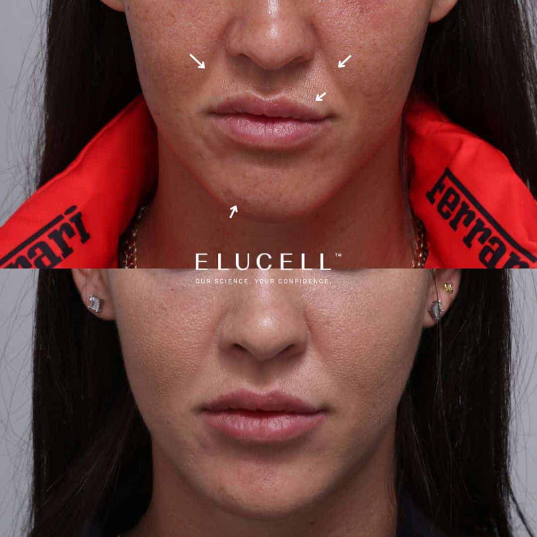 Nonsurgical Facelift Thread Lift Treatment - Elucell