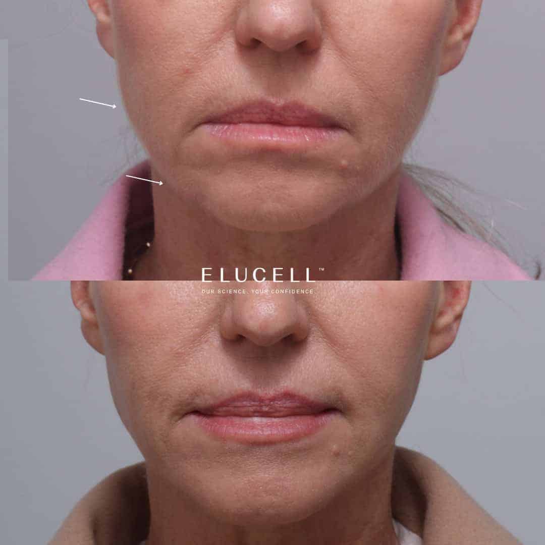 Lower Face Thread Lift Treatment Melbourne - Elucell - Elucell