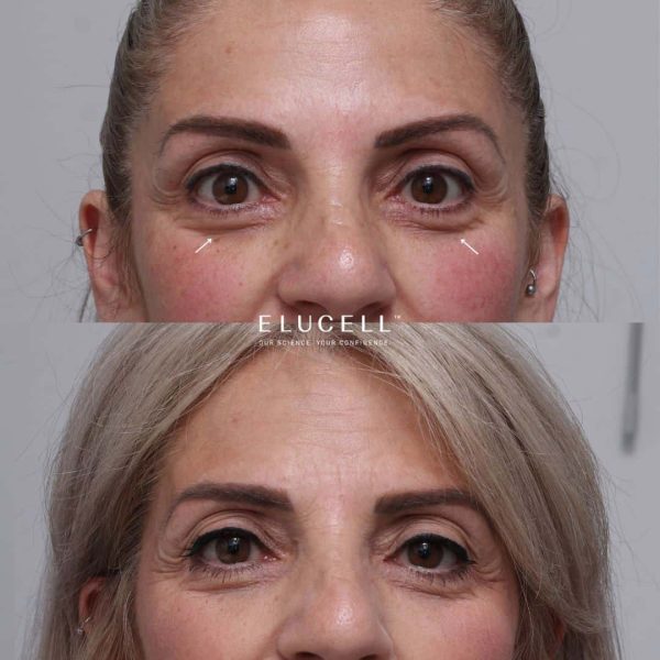 Nonsurgical Facelift Thread Lift Treatment - Elucell