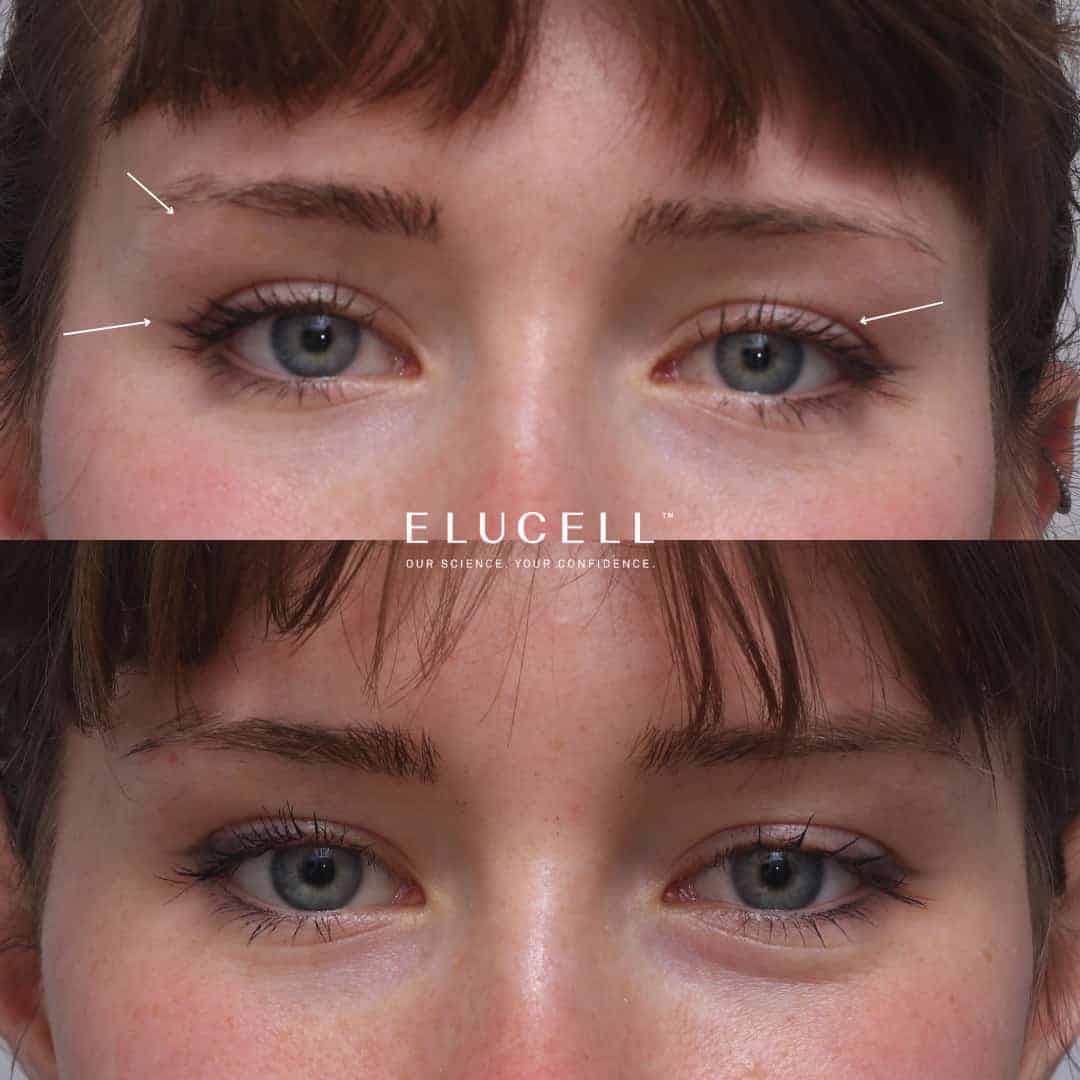 Mono Rejuvenation Threads For Skin Tighening - Elucell - Elucell