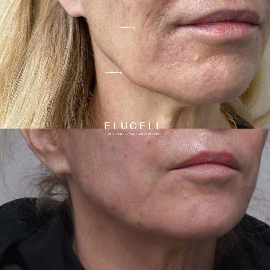 Nonsurgical Facelift Thread Lift Treatment - Elucell
